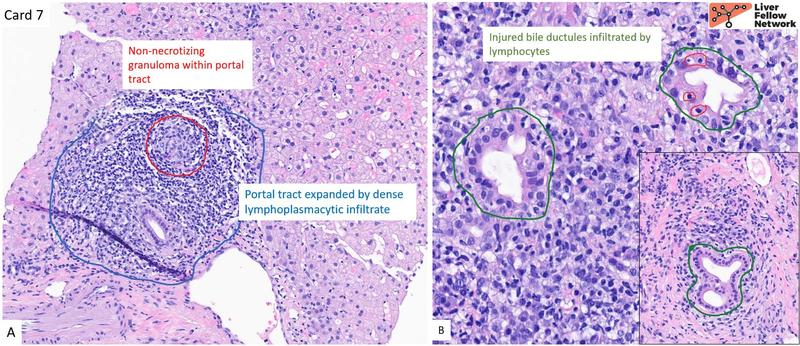Liver Pathology | AASLD